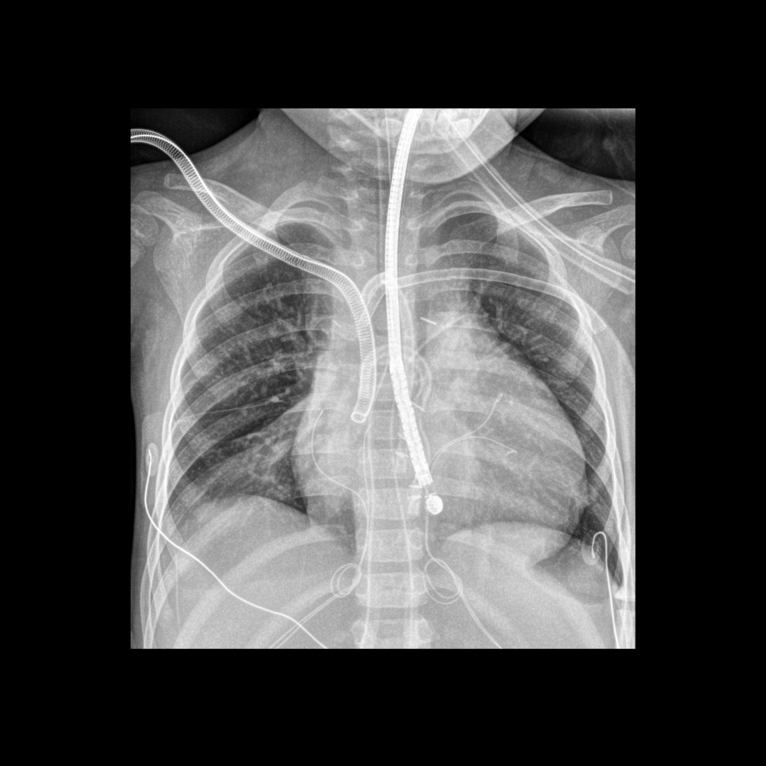Pediatric Nasogastric Tube Malfunction / Malposition / Misposition ...