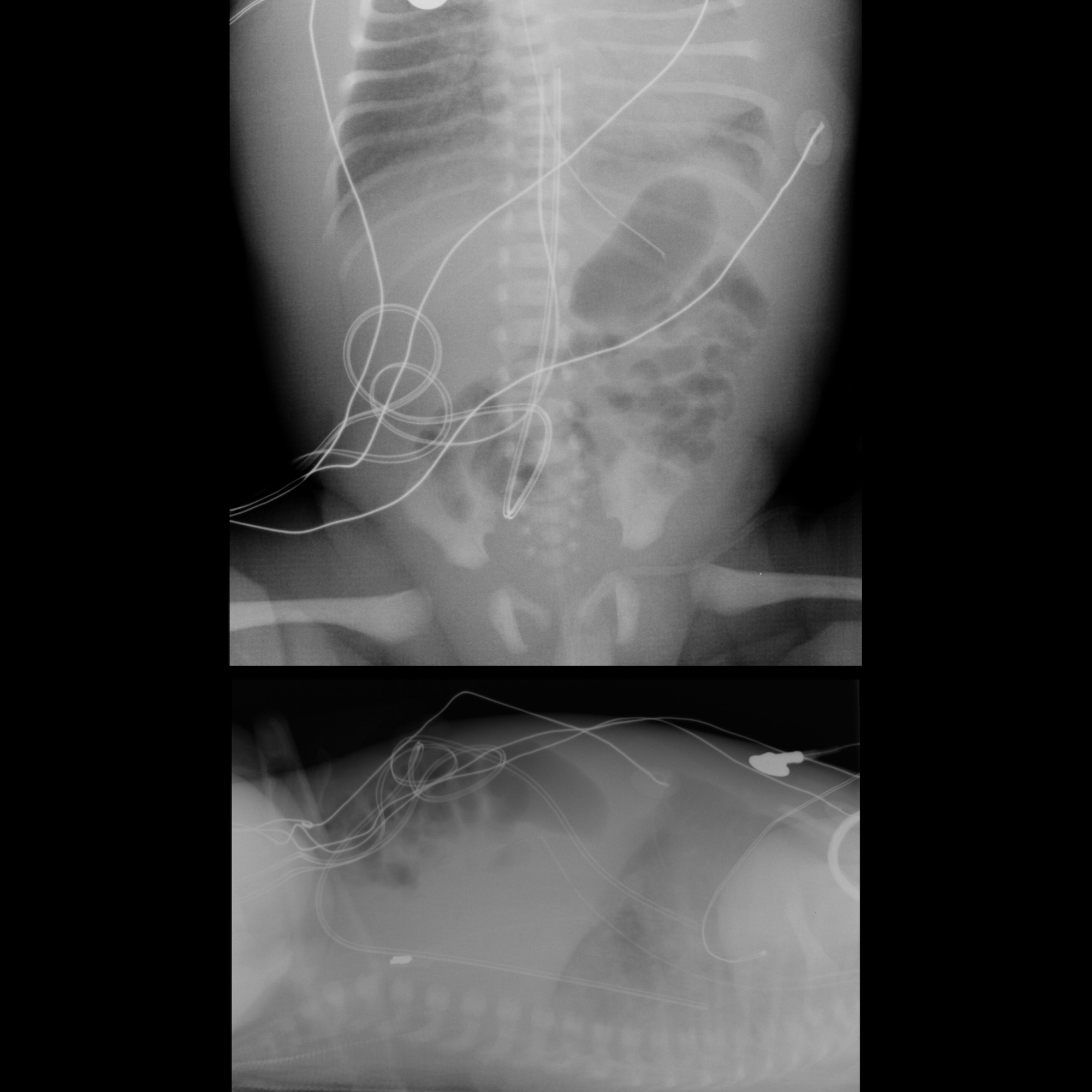 Umbilical Arterial Catheter Malfunction / Malposition / Misposition ...