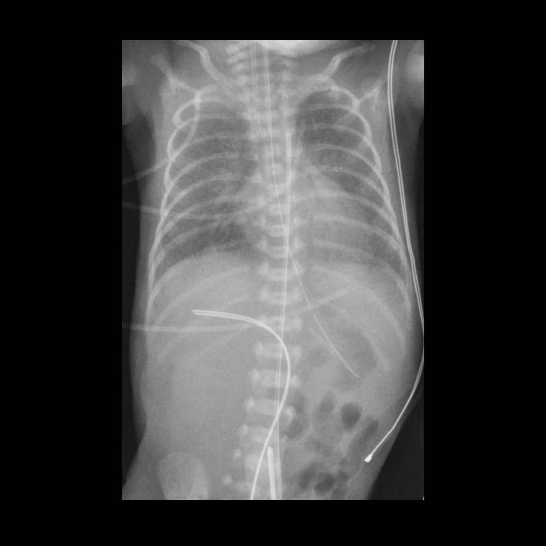 Umbilical Venous Catheter Malfunction / Malposition / Misposition ...