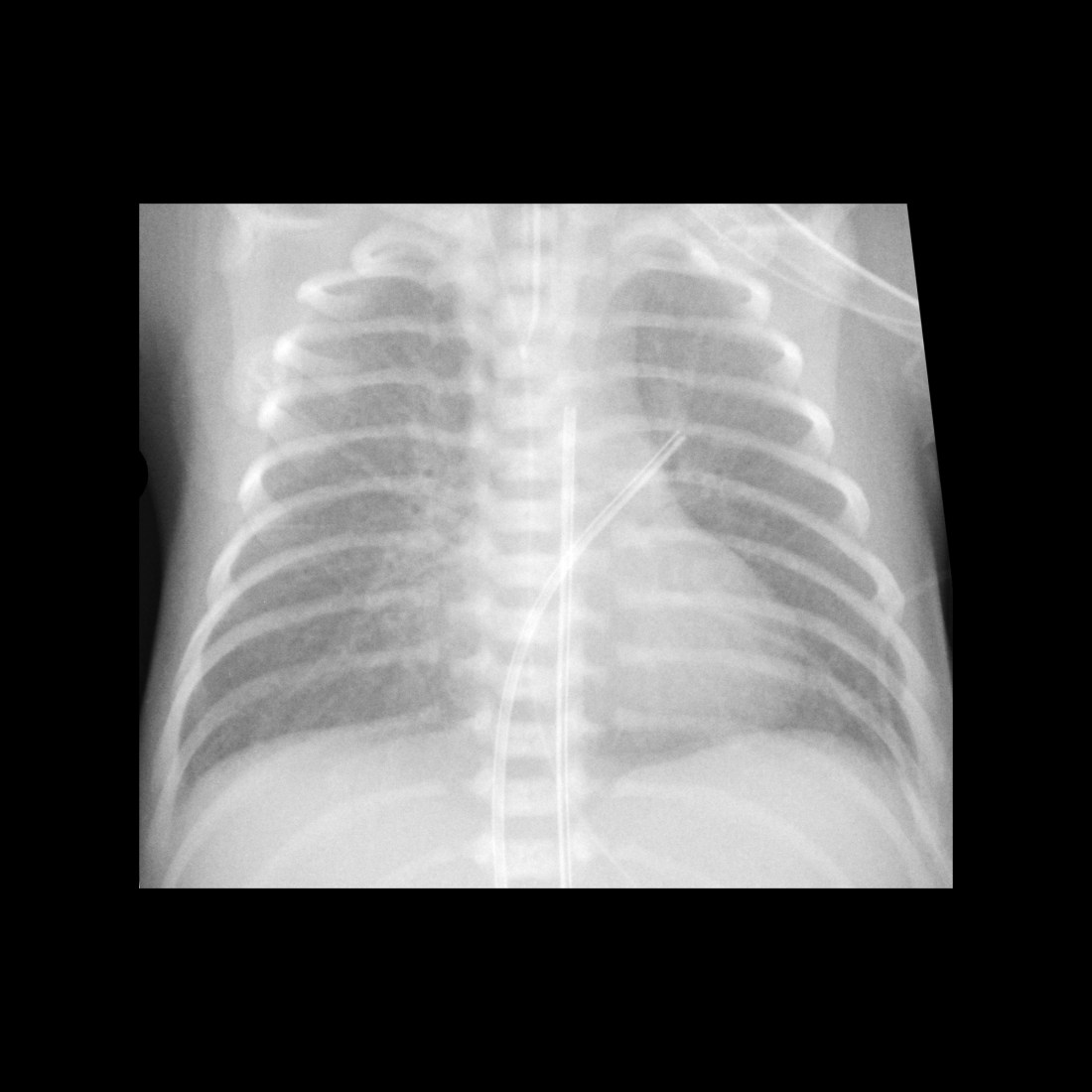 Umbilical Venous Catheter Malfunction / Malposition / Misposition ...