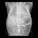 Pediatric Endotracheal Tube Malfunction / Malposition / Misposition ...