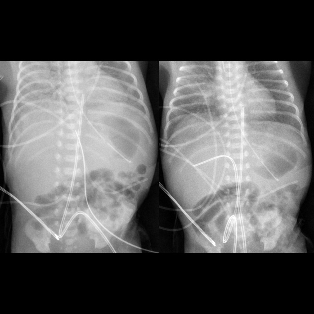 Premature newborn status umbilical venous catheter placement ...