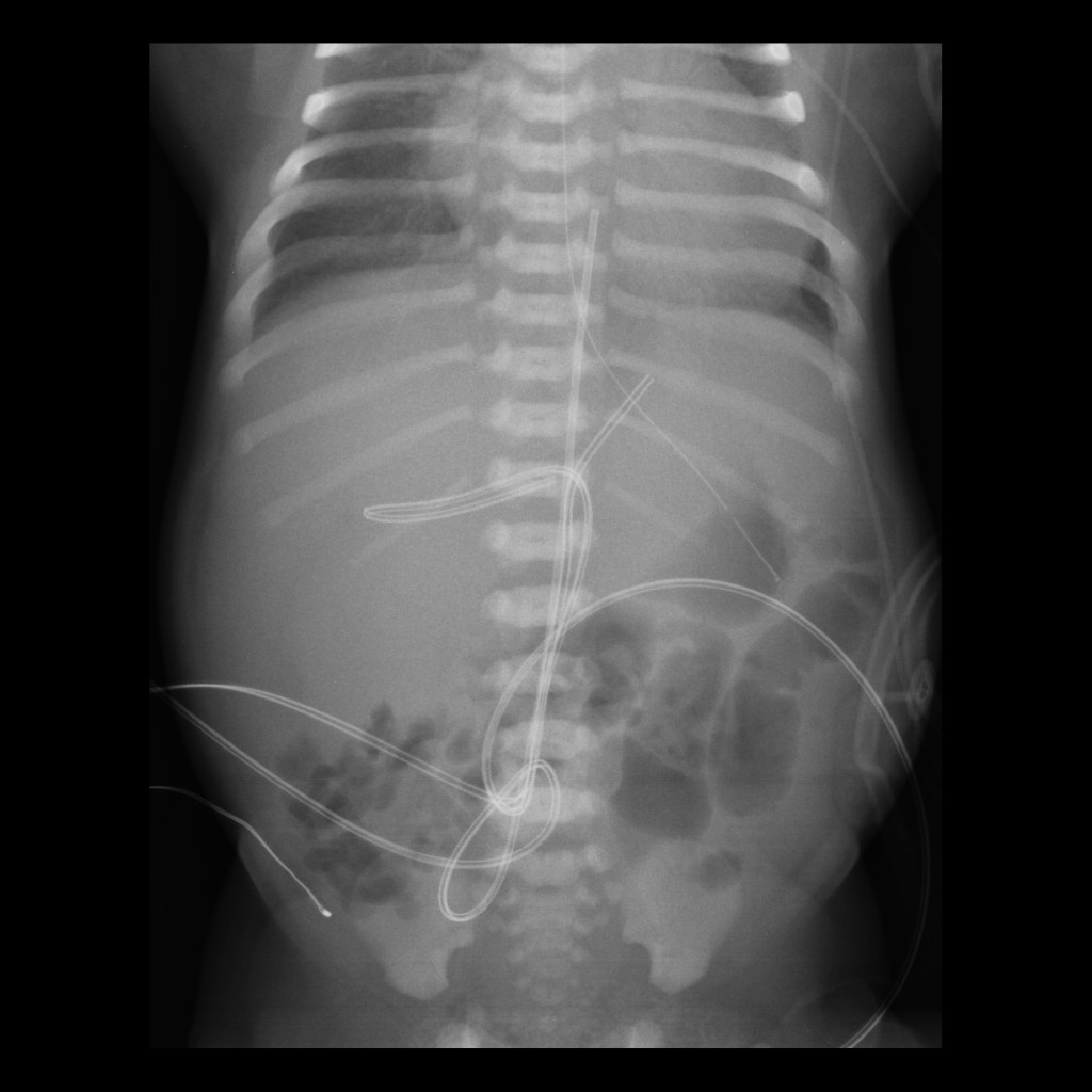 Premature newborn who has had two umbilical venous catheters placed ...