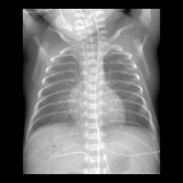 Umbilical Venous Catheter Malfunction / Malposition / Misposition ...