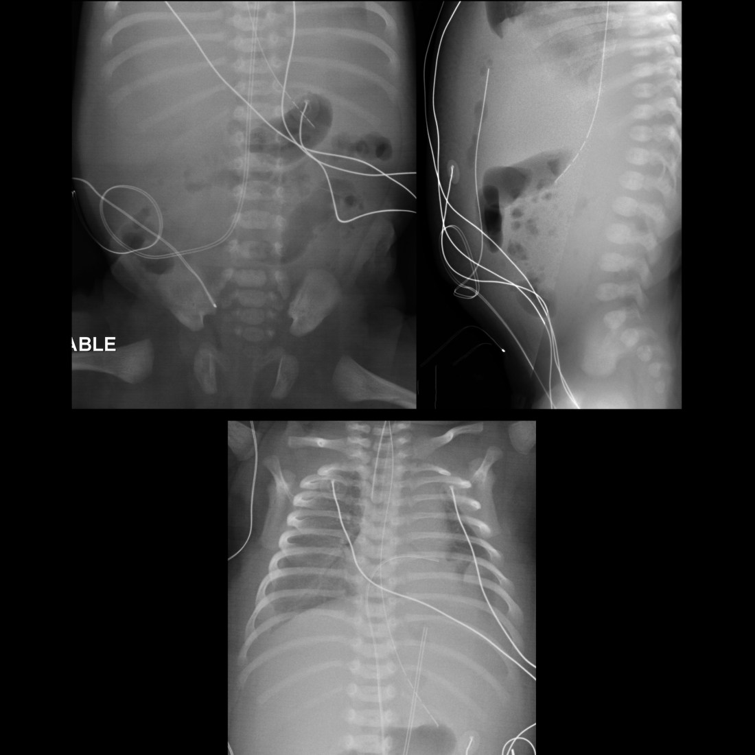 Umbilical Venous Catheter Malfunction / Malposition / Misposition ...