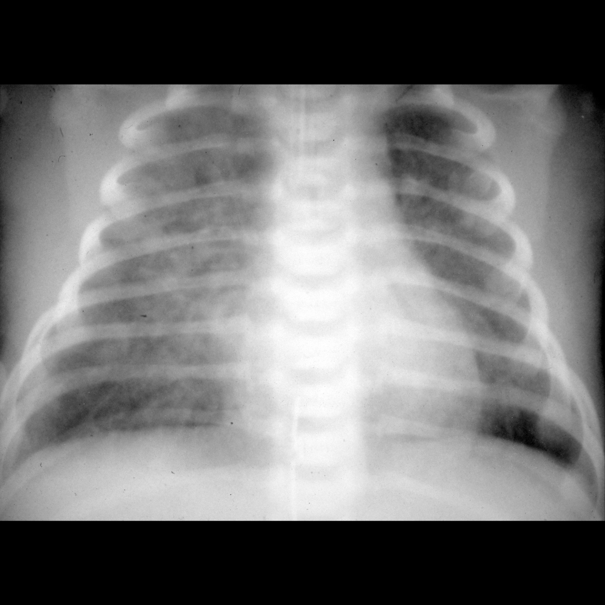 Meconium Aspiration Syndrome | Pediatric Radiology Reference Article ...