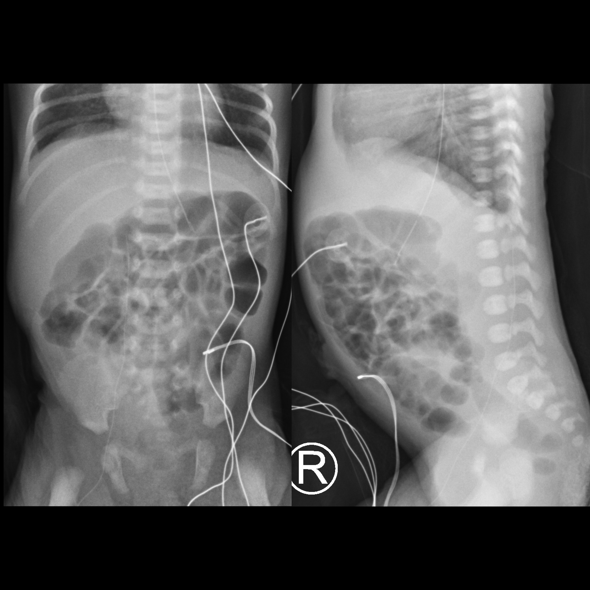 Premature newborn after PICC placement | Pediatric Radiology Case ...