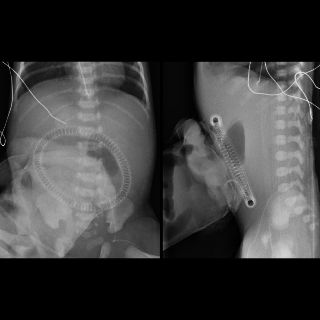 Gastroschisis | Pediatric Radiology Reference Article | Pediatric ...