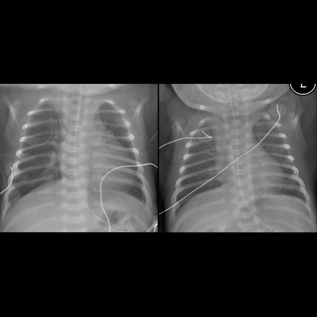 Premature newborn after PICC placement | Pediatric Radiology Case ...