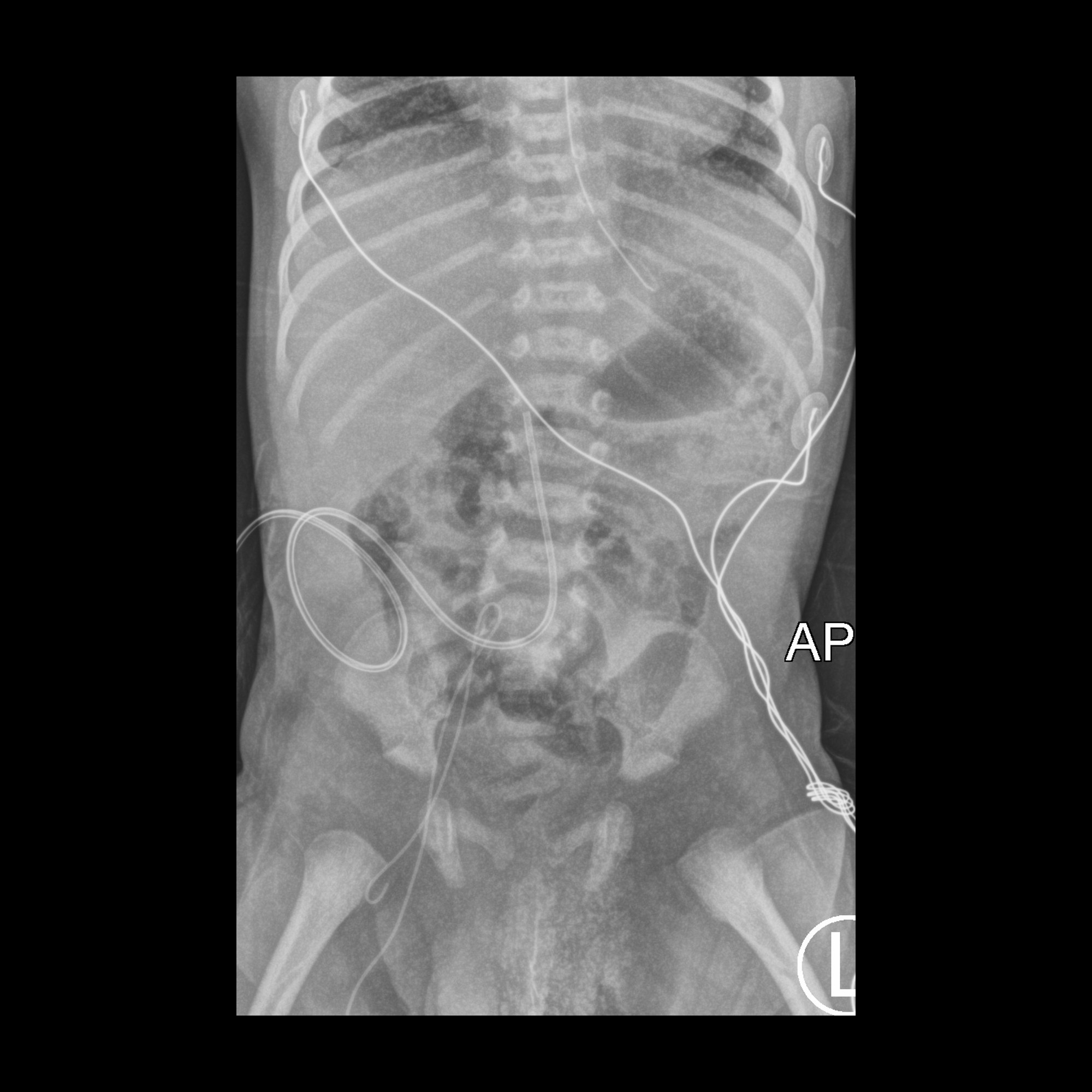 Premature newborn after PICC placement | Pediatric Radiology Case ...