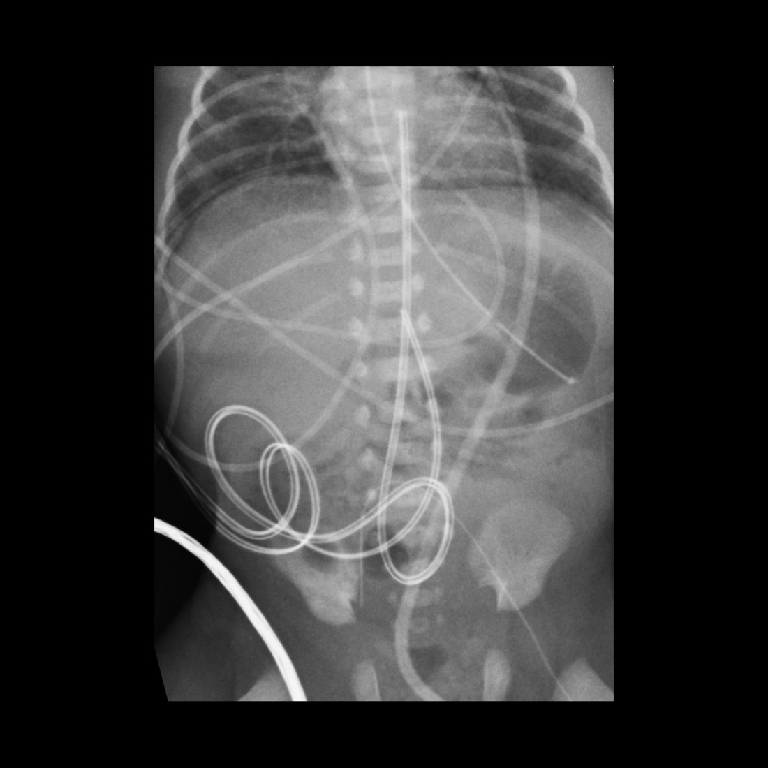 Pediatric Peripherally Inserted Central Catheter Malfunction ...