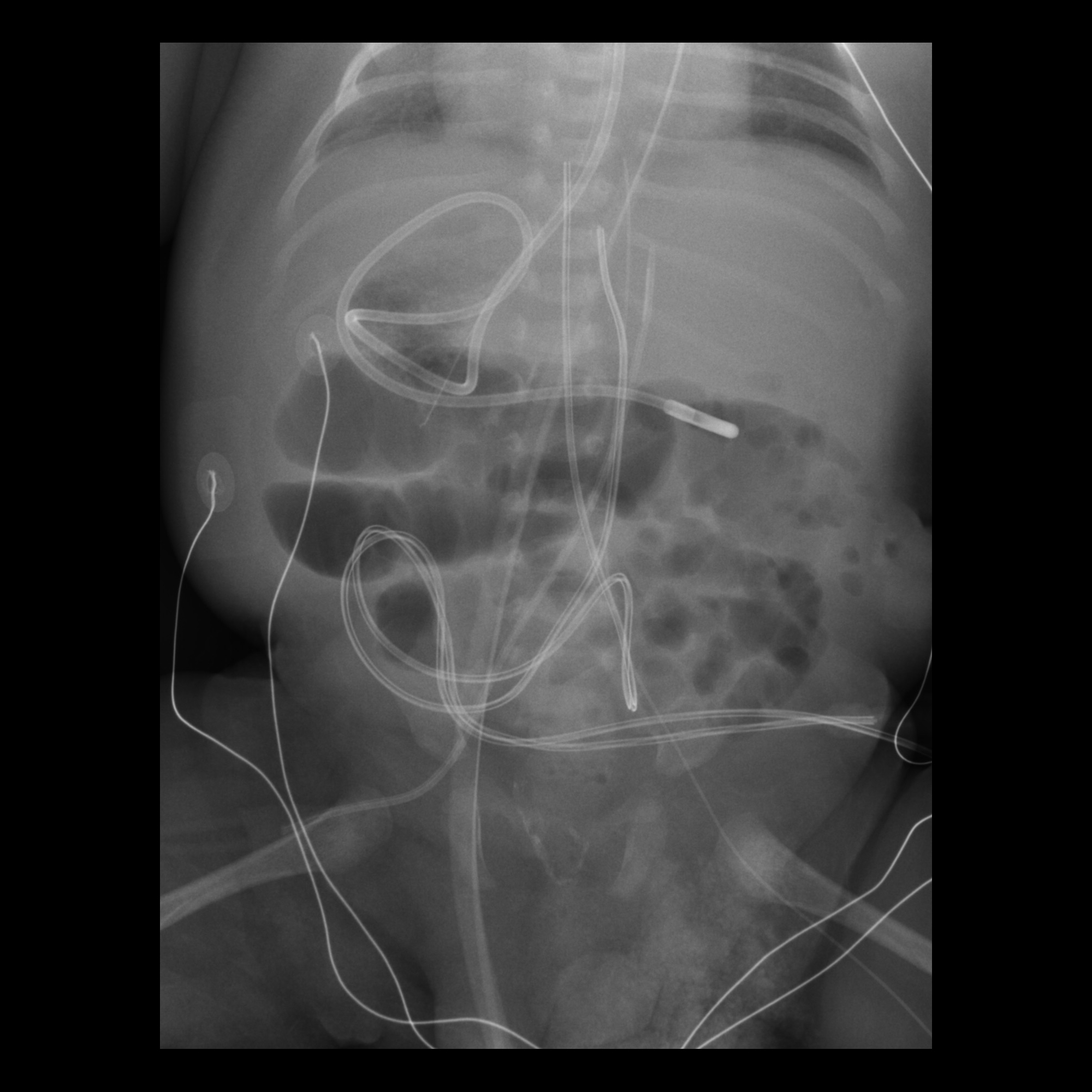 Heterotaxy Syndrome | Pediatric Radiology Reference Article | Pediatric ...
