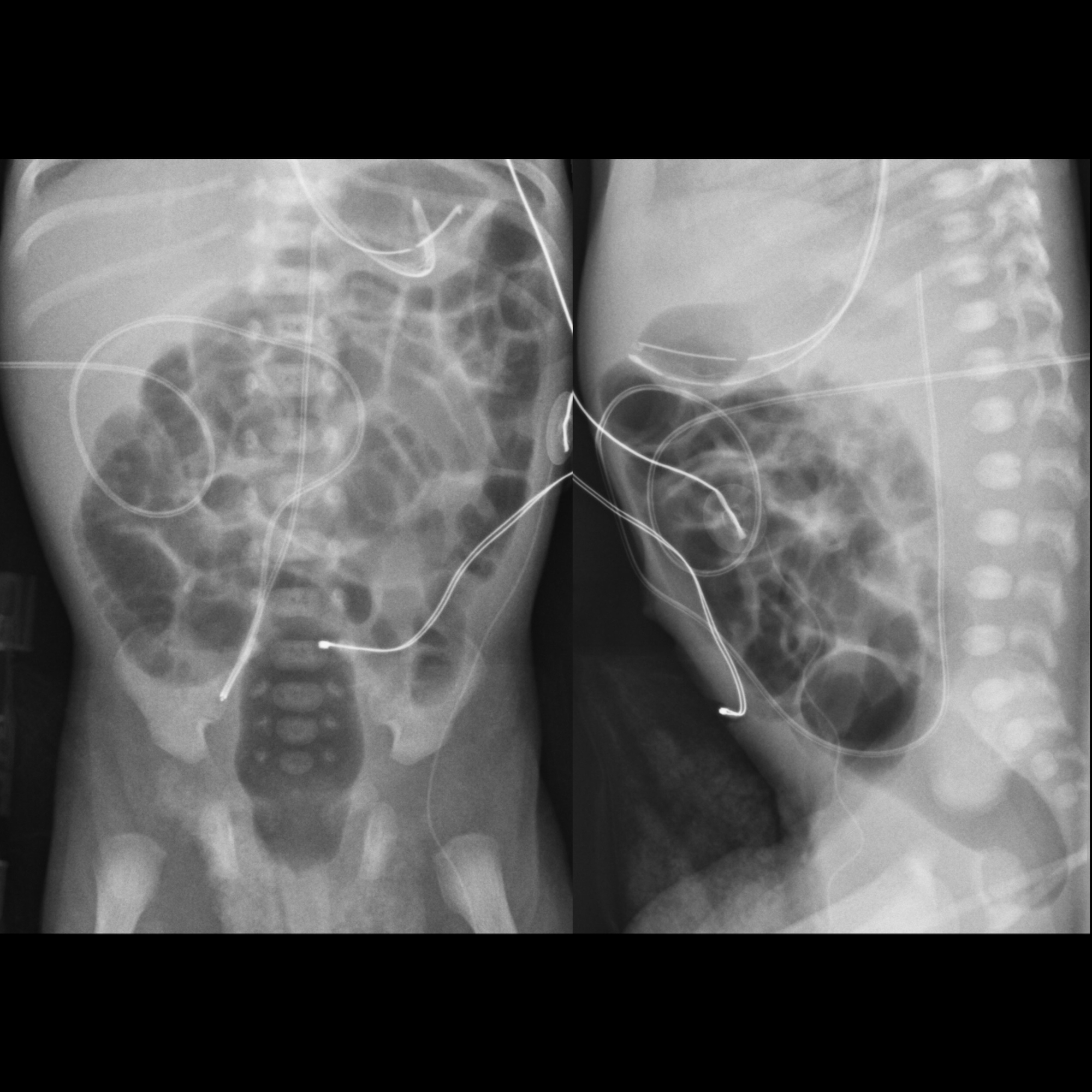 Premature newborn after PICC placement | Pediatric Radiology Case ...
