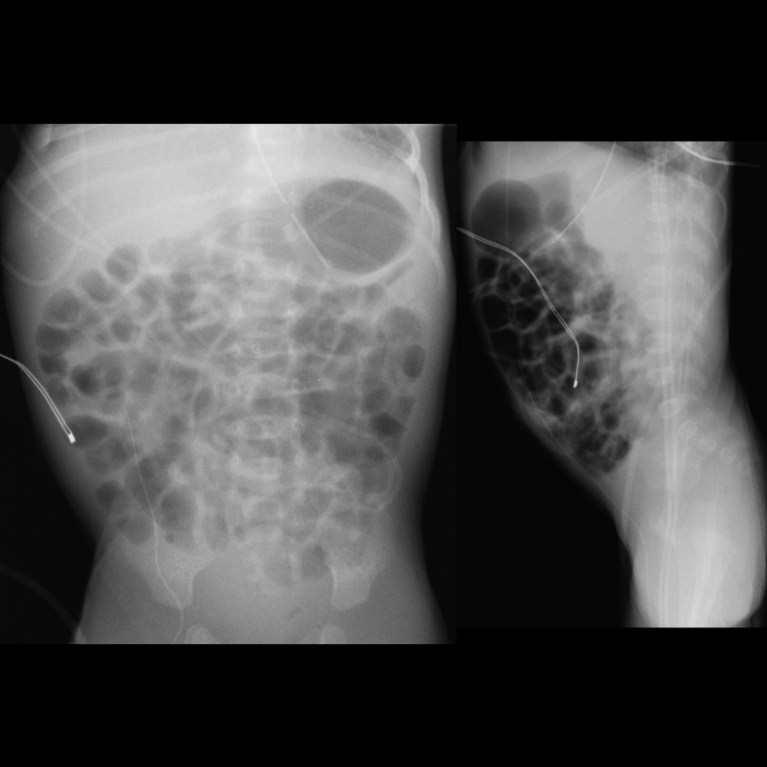 Premature newborn after PICC placement | Pediatric Radiology Case ...
