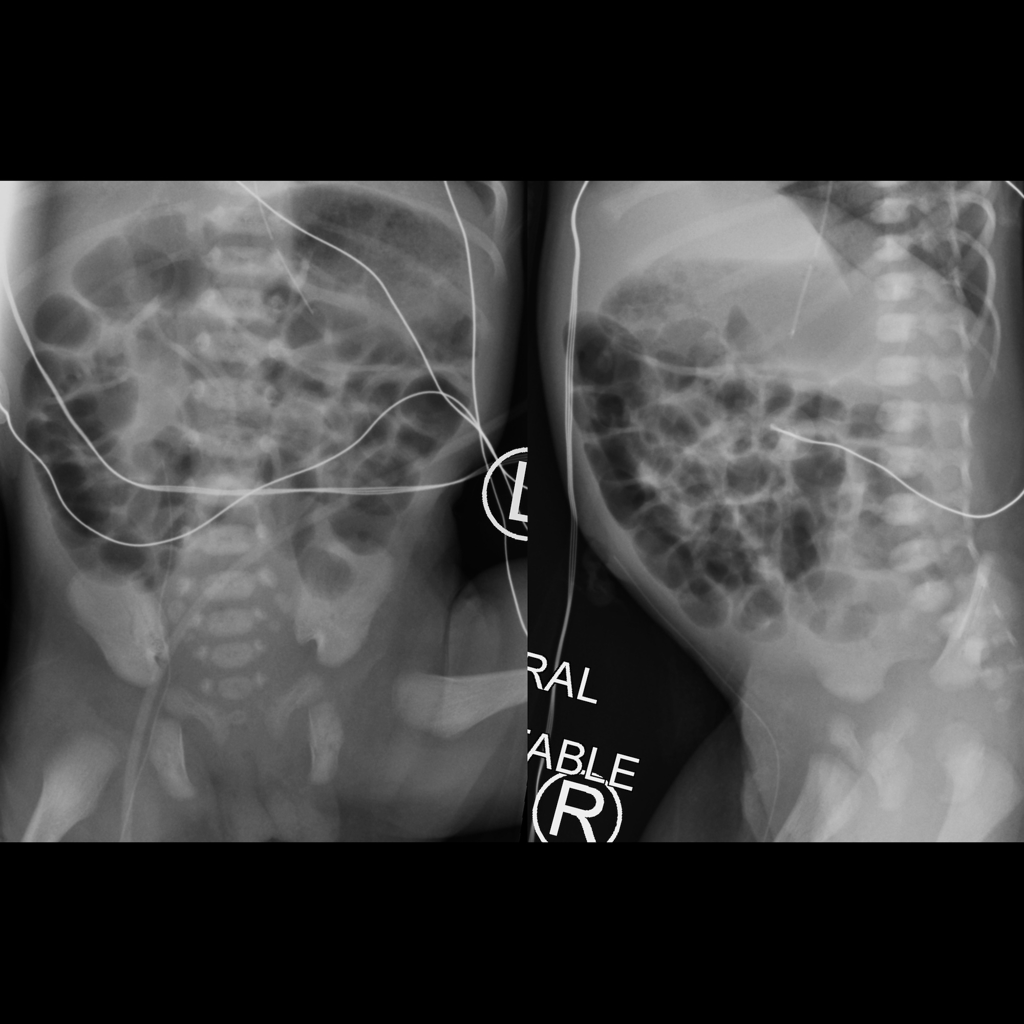 Premature newborn after PICC placement | Pediatric Radiology Case ...