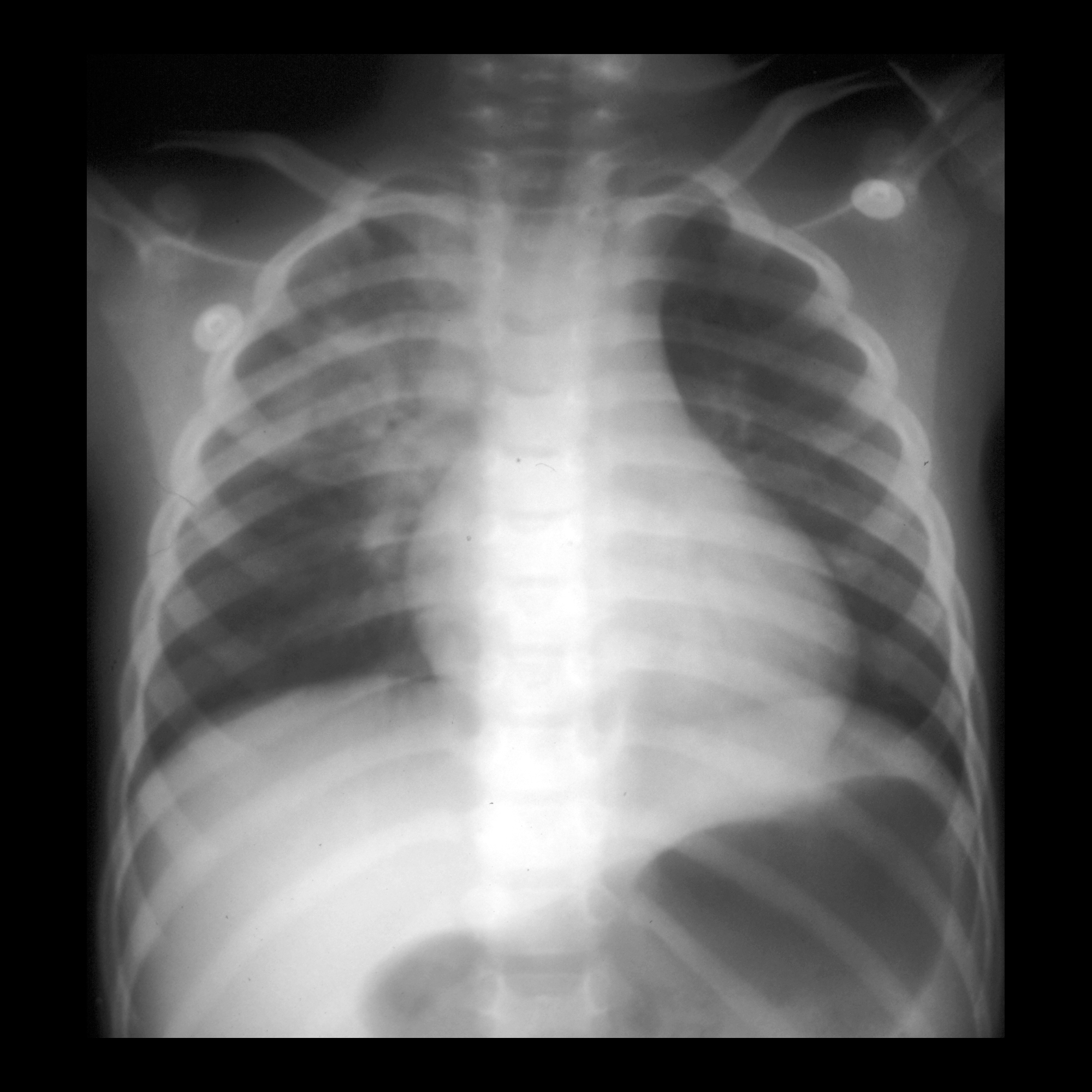 Pediatric Aspiration Pneumonia | Pediatric Radiology Reference Article ...