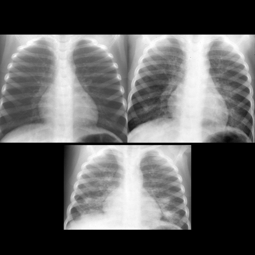 Pediatric Lipoid Pneumonia | Pediatric Radiology Reference Article ...