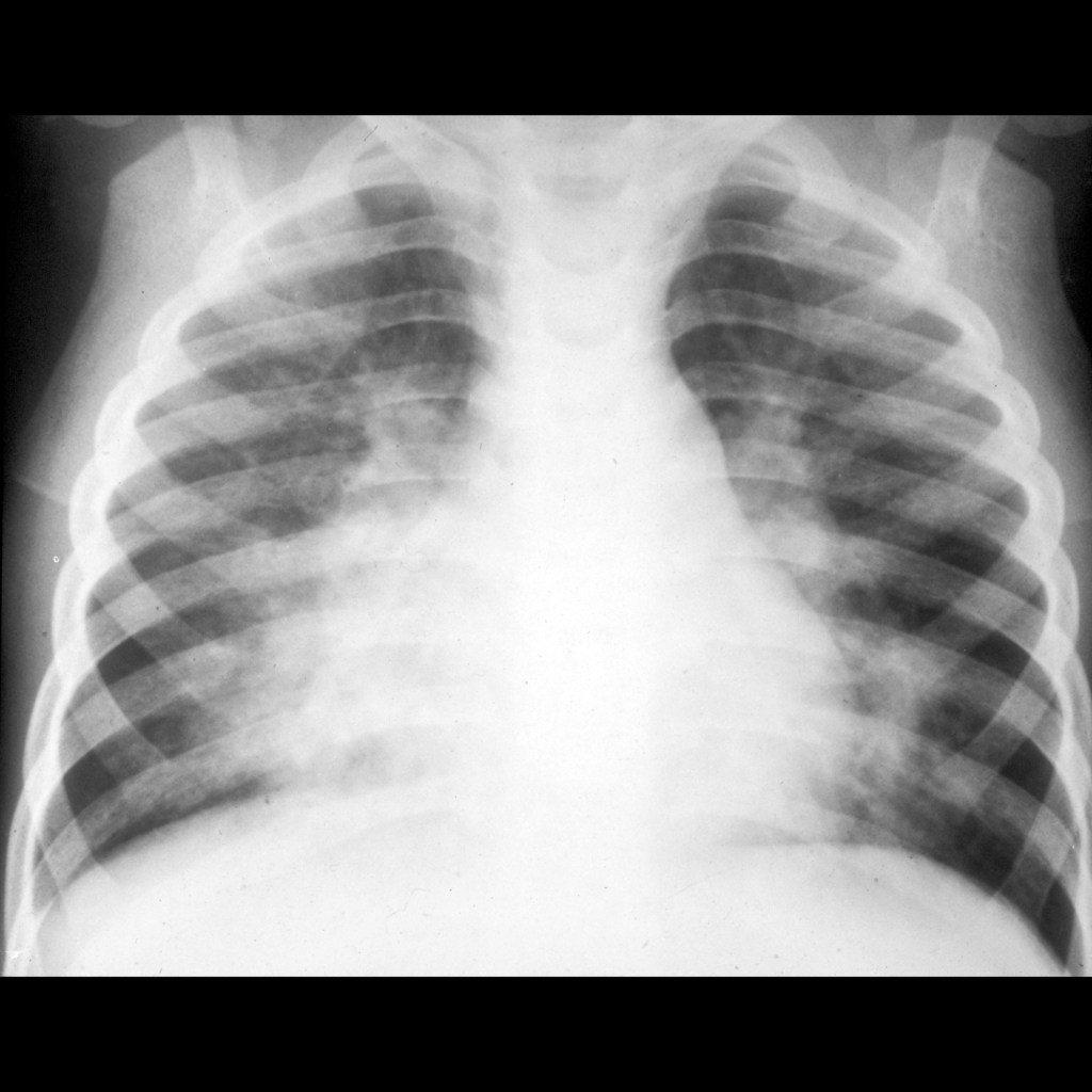 Pediatric Lipoid Pneumonia | Pediatric Radiology Reference Article ...
