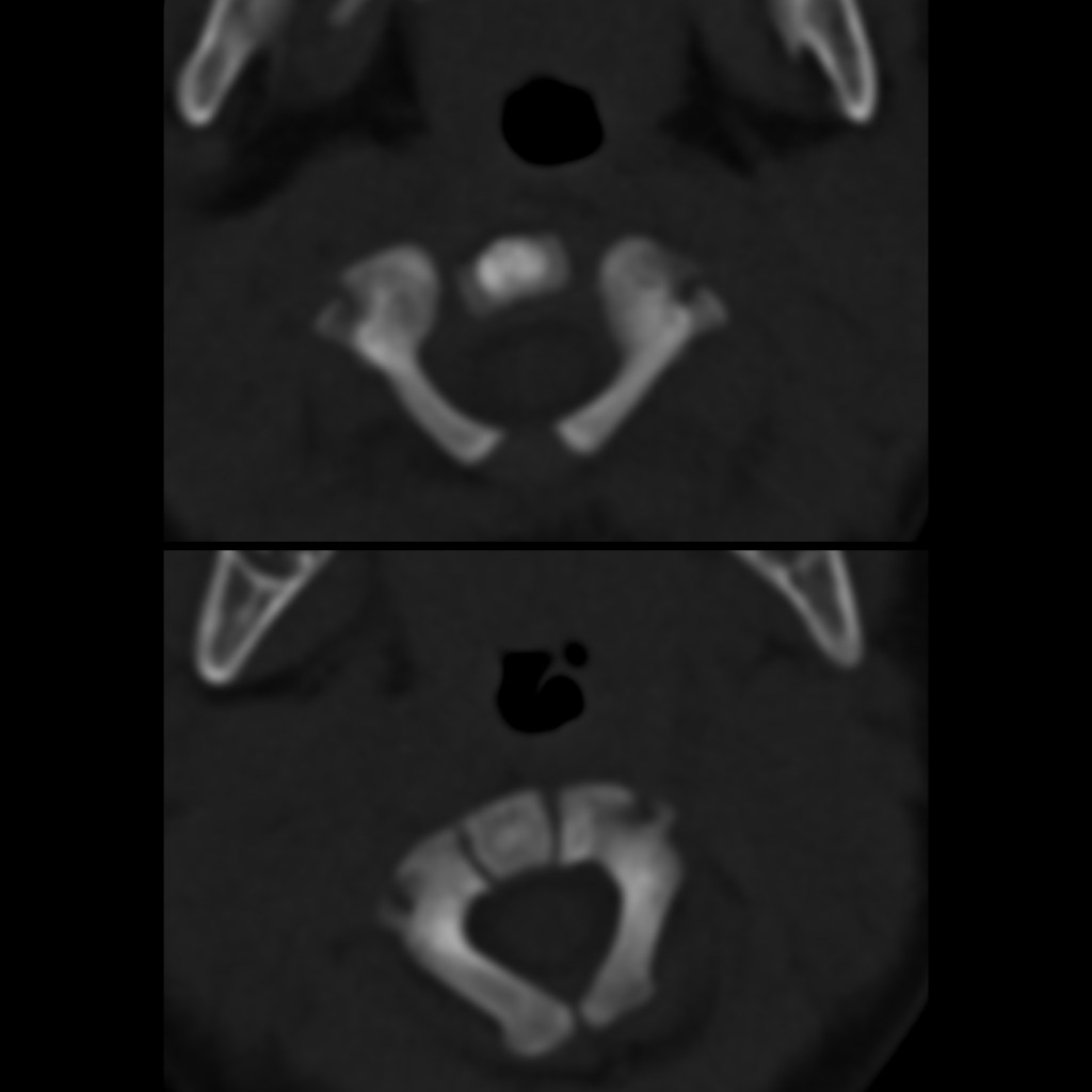 Pediatric Atlanto Axial Rotatory Subluxation | Pediatric Radiology ...