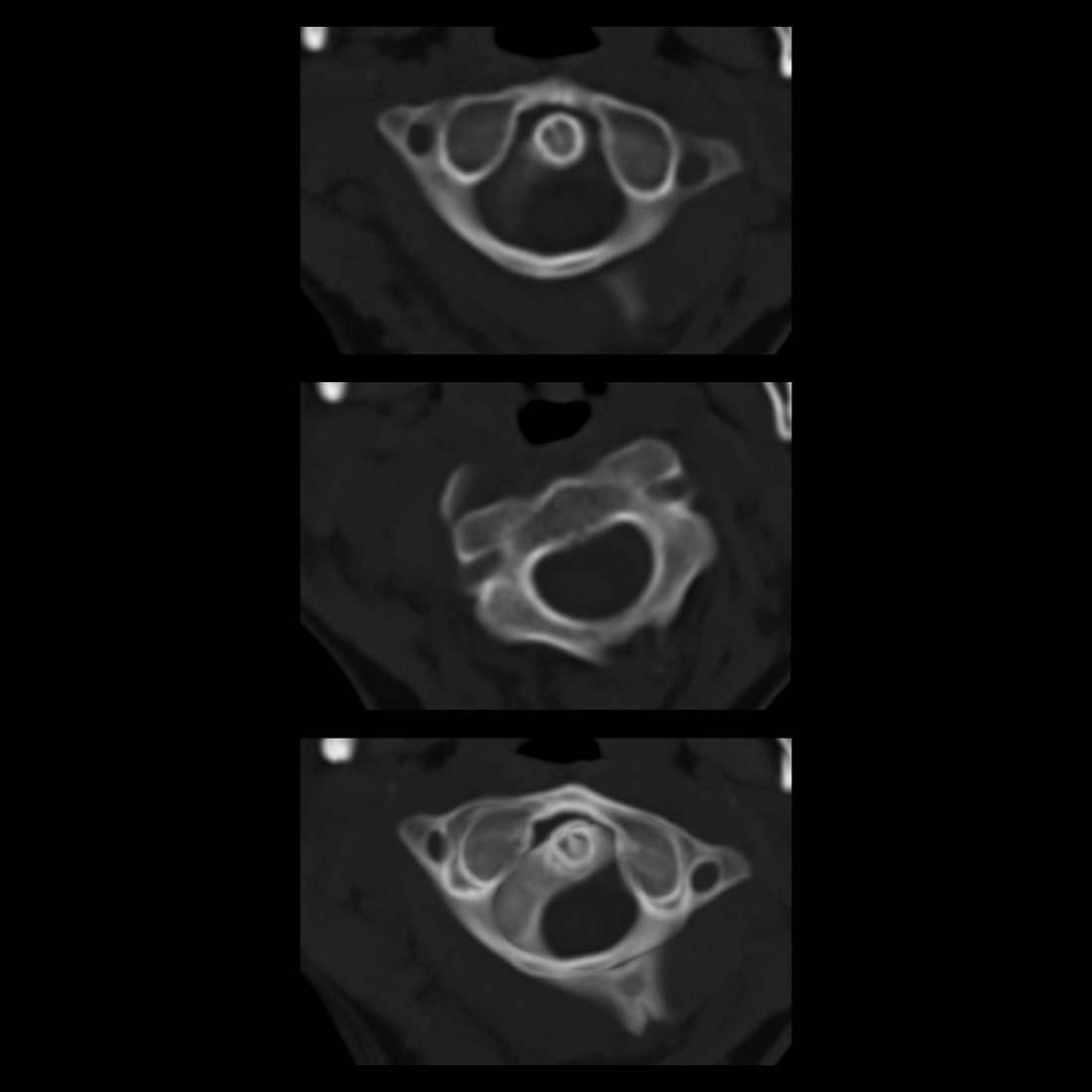Pediatric Atlanto Axial Rotatory Subluxation | Pediatric Radiology ...