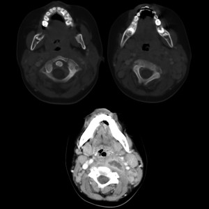 Pediatric Retropharyngeal Abscess | Pediatric Radiology Reference ...