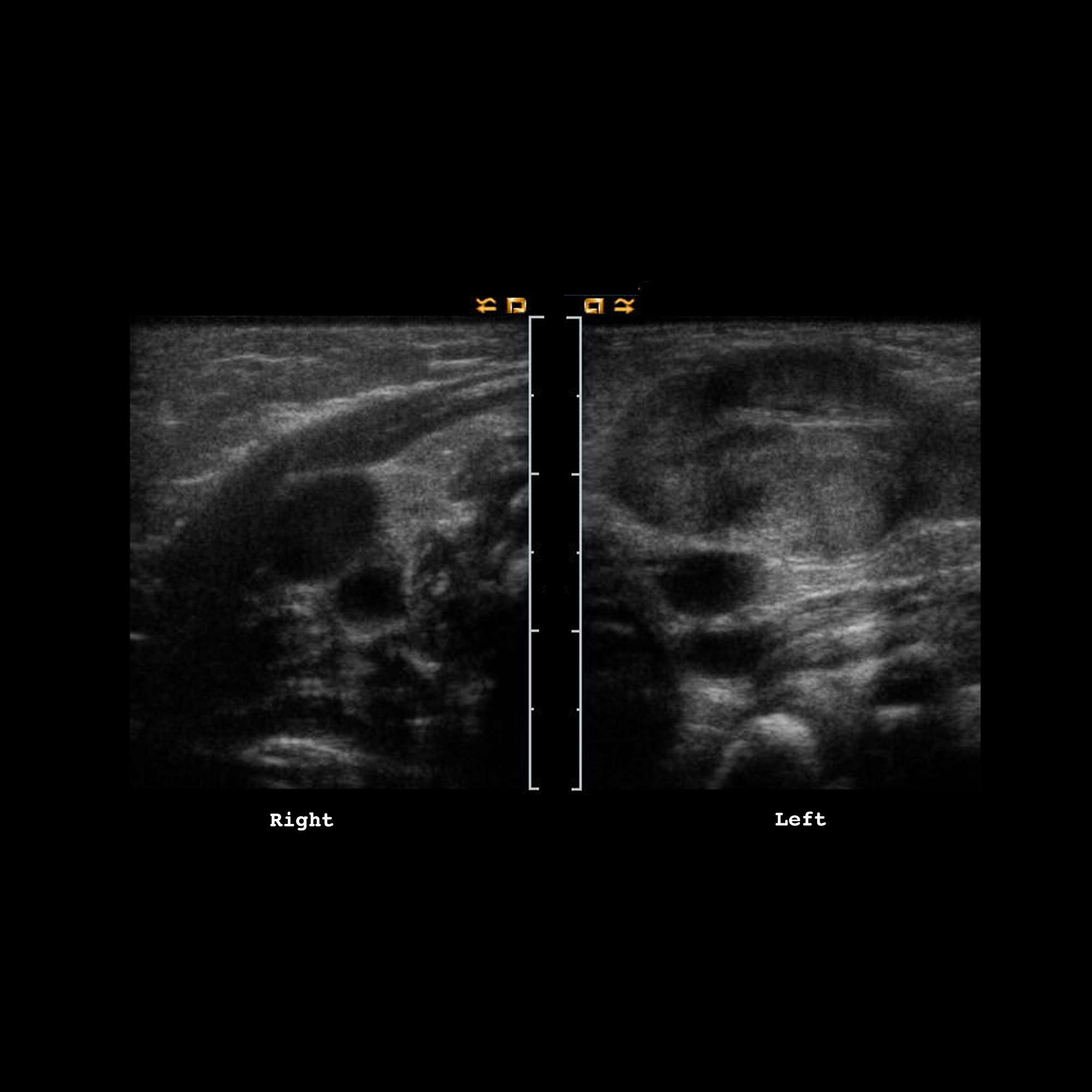 Infant with torticollis since birth and a left neck mass | Pediatric ...