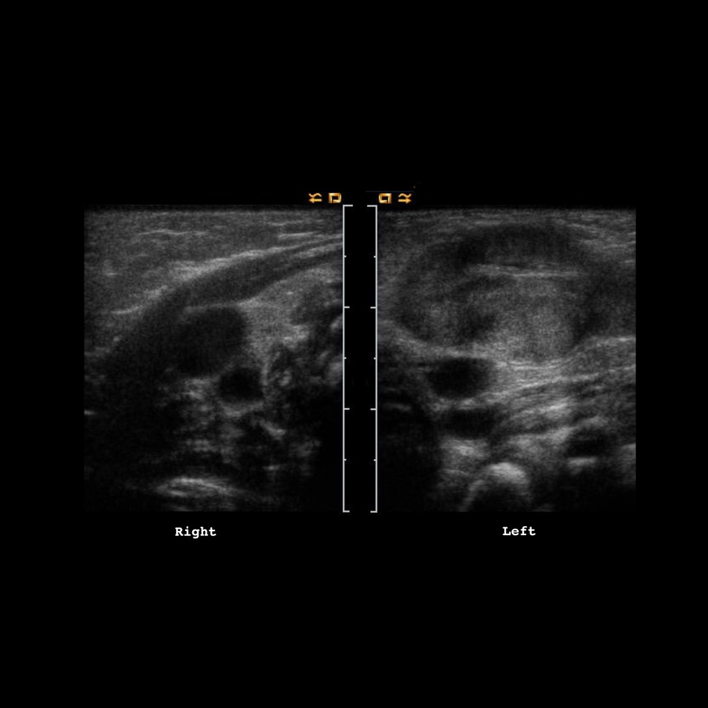 Fibromatosis Colli | Pediatric Radiology Reference Article | Pediatric ...