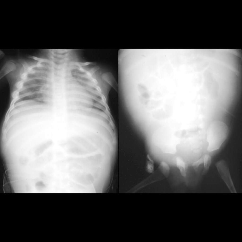 Child Abuse Visceral Injury | Pediatric Radiology Reference Article ...