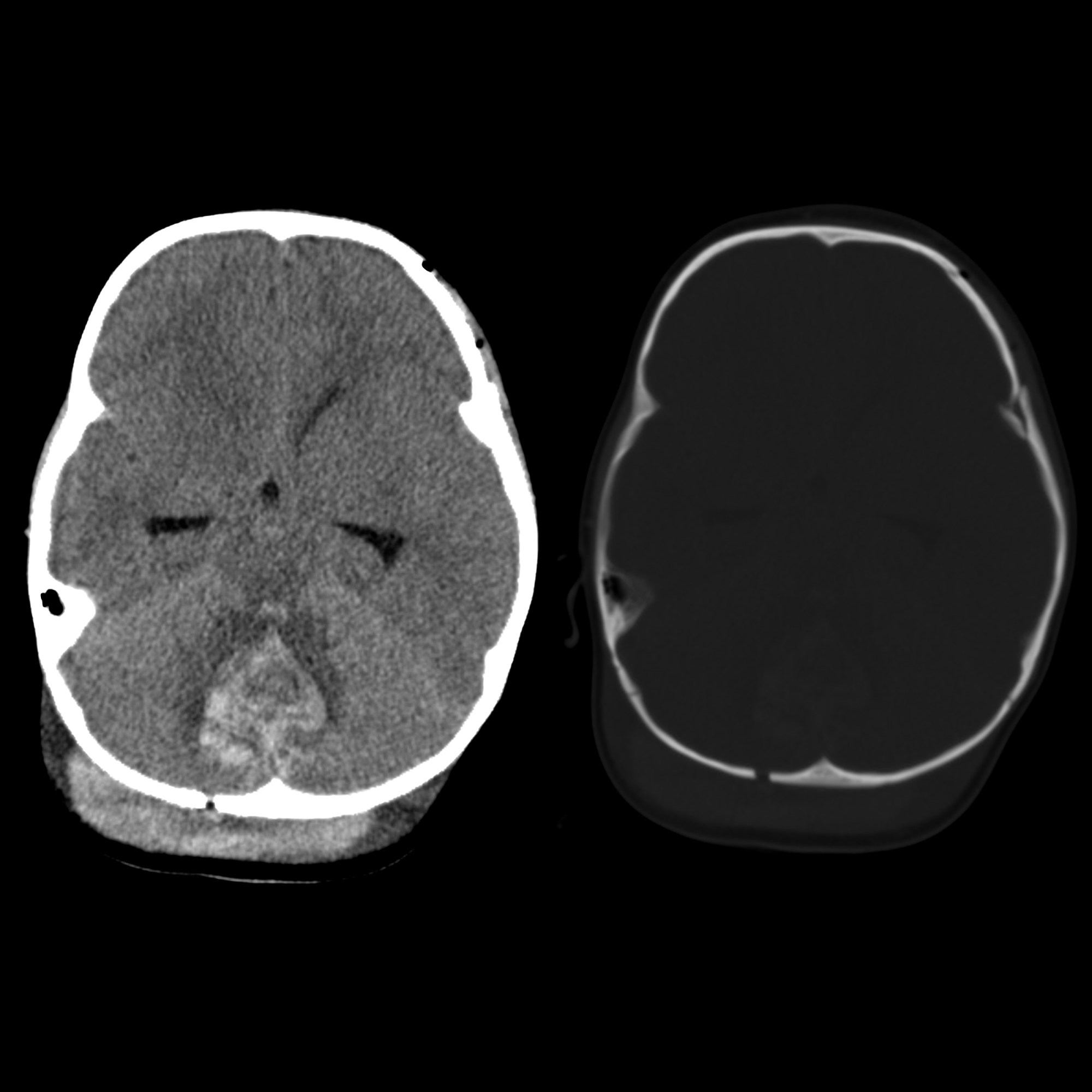 Pediatric Skull Fracture | Pediatric Radiology Reference Article ...