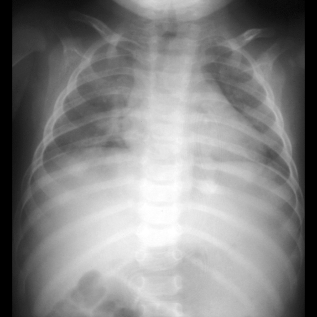 Pediatric Rib Fracture | Pediatric Radiology Reference Article ...
