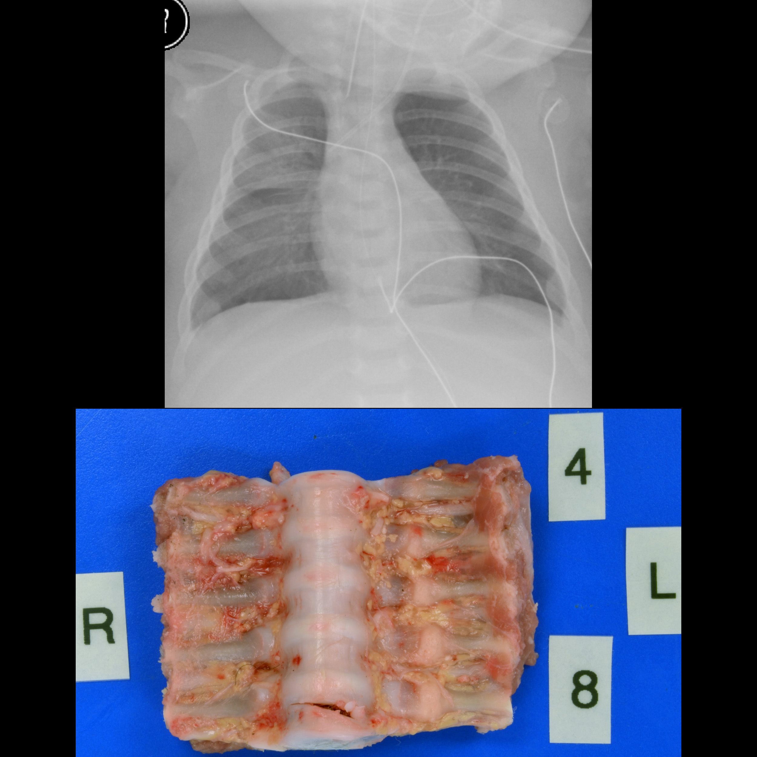 Pediatric Rib Fracture | Pediatric Radiology Reference Article ...