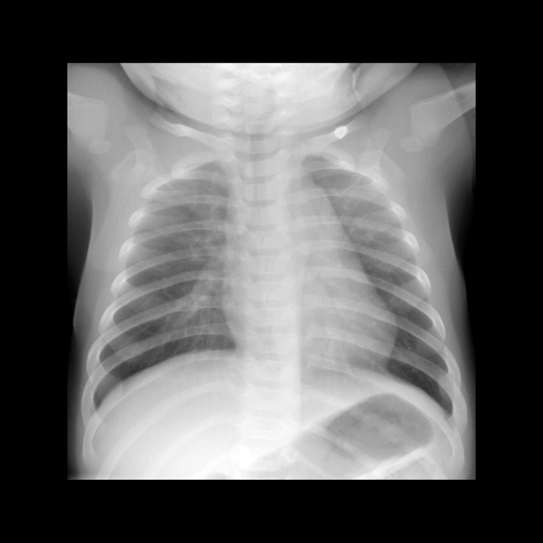 Pediatric Rib Fracture | Pediatric Radiology Reference Article ...