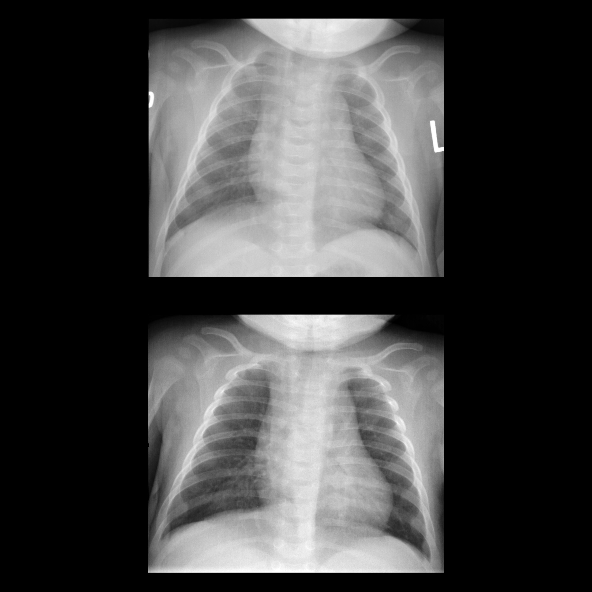 Pediatric Rib Fracture | Pediatric Radiology Reference Article ...