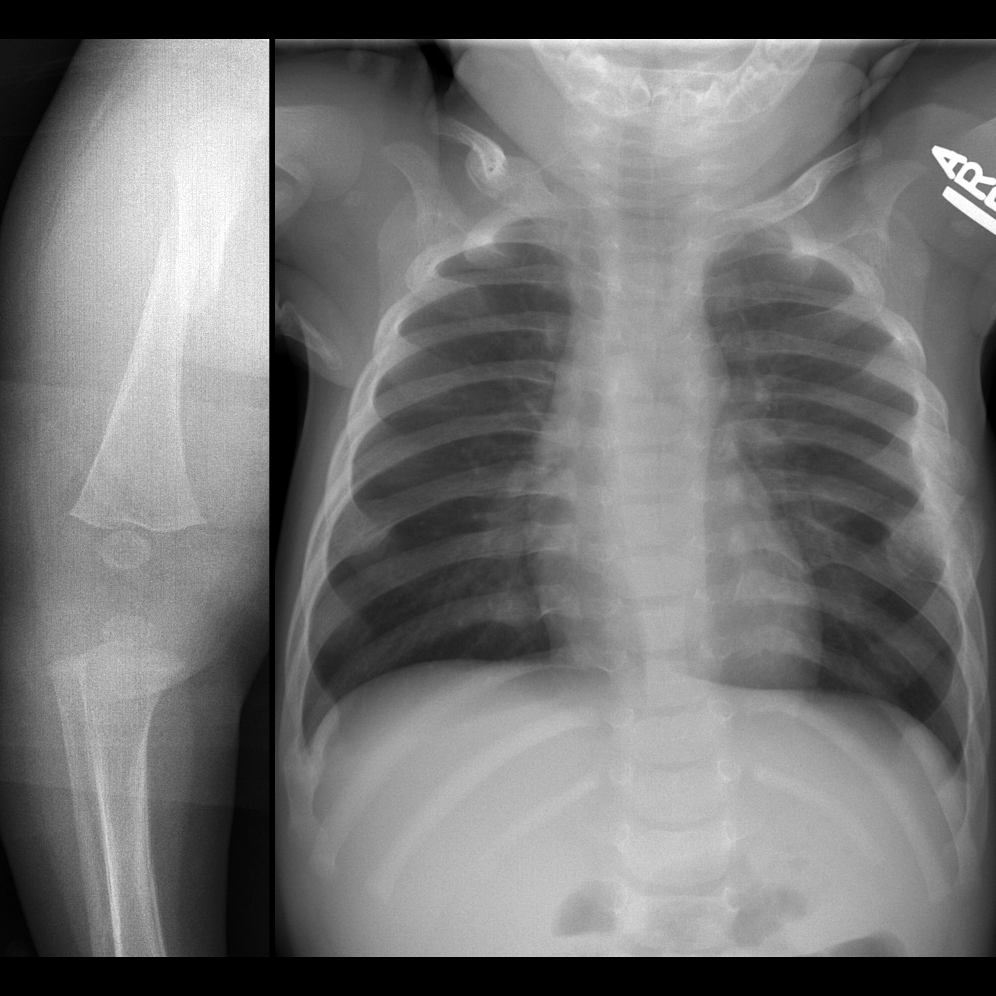 Pediatric Rib Fracture | Pediatric Radiology Reference Article ...