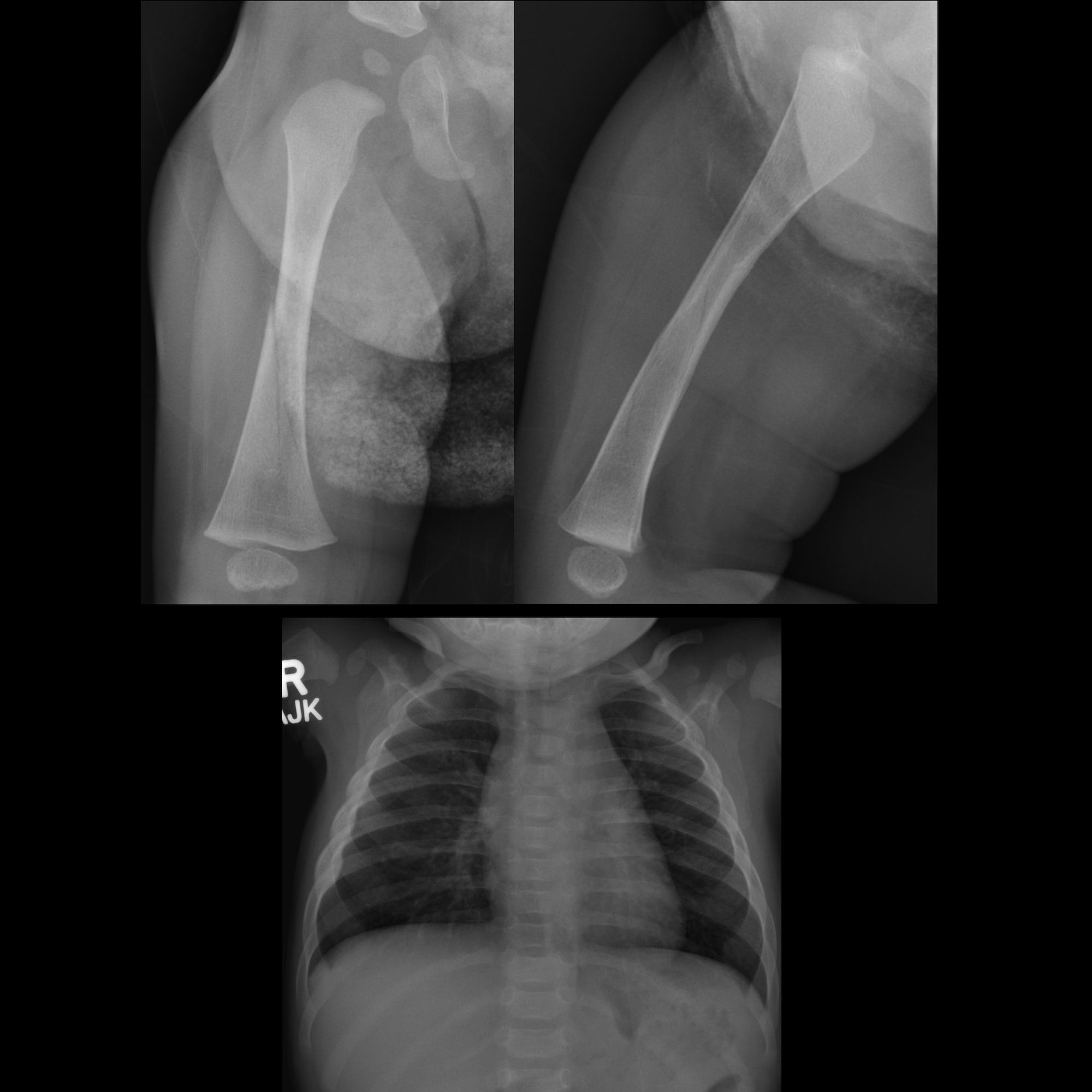 Pediatric Rib Fracture | Pediatric Radiology Reference Article ...