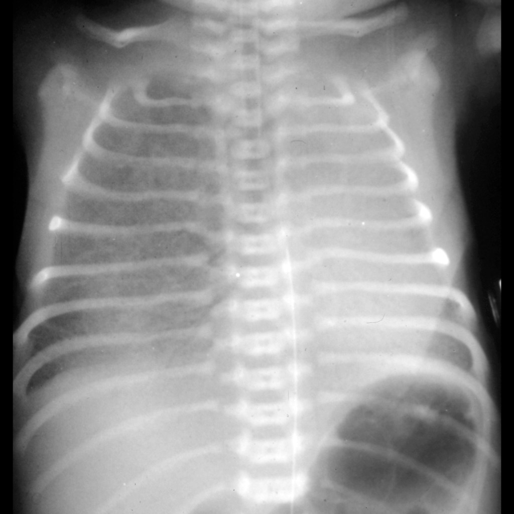 Premature newborn with respiratory distress on a ventilator | Pediatric ...