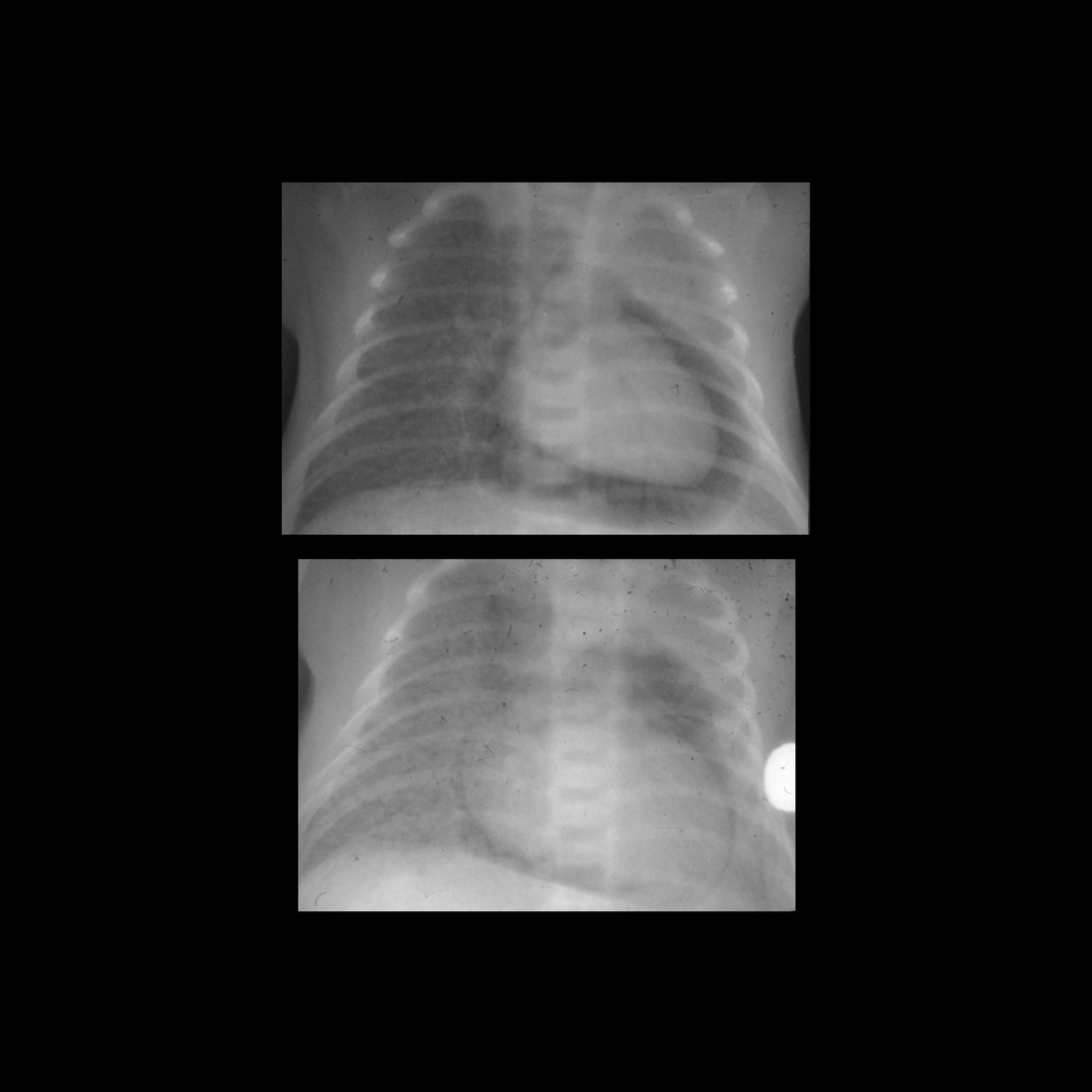 Respiratory Distress Syndrome | Pediatric Radiology Reference Article ...