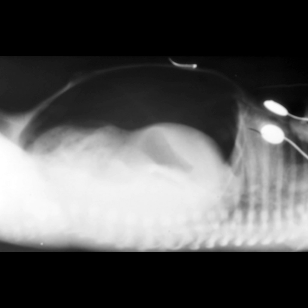 Pediatric Pneumoperitoneum | Pediatric Radiology Reference Article ...