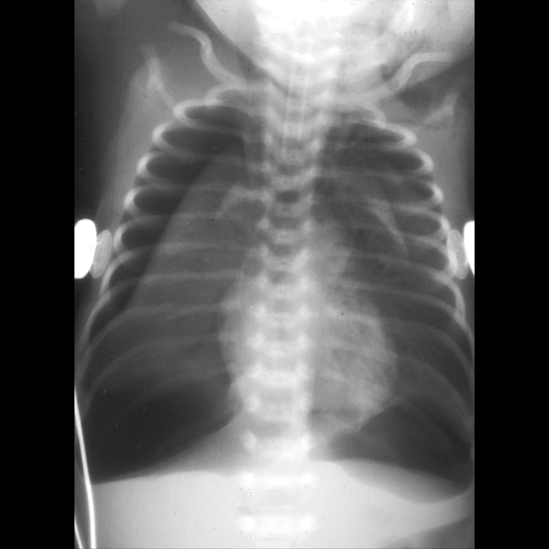 Pediatric Pneumothorax | Pediatric Radiology Reference Article ...