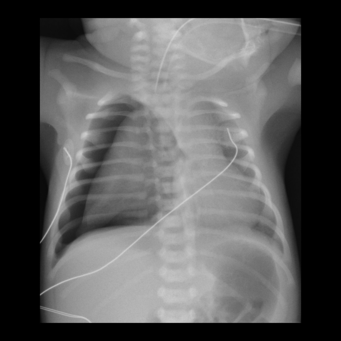 Pediatric Pneumothorax | Pediatric Radiology Reference Article ...