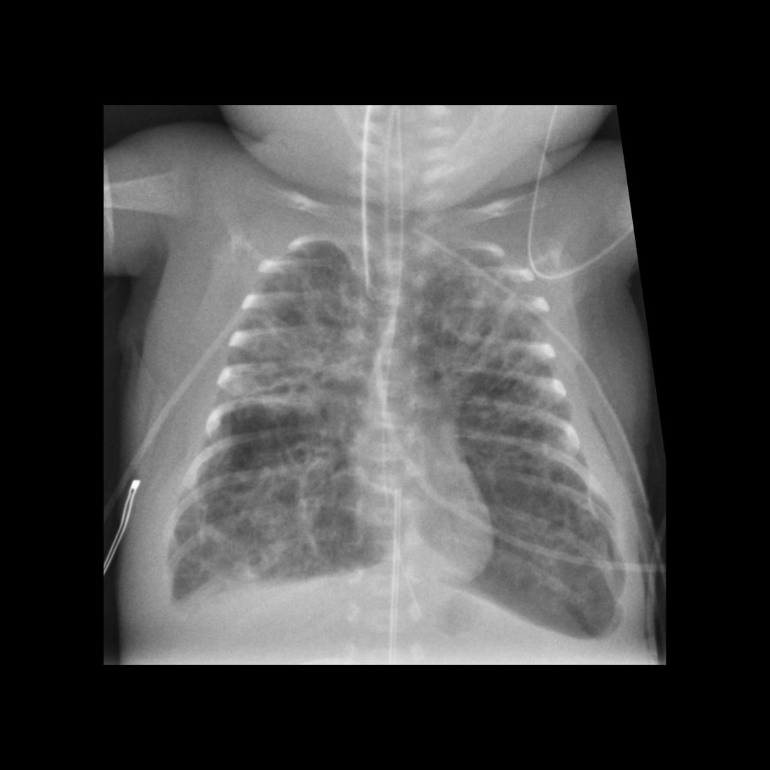Pediatric Pneumothorax | Pediatric Radiology Reference Article ...