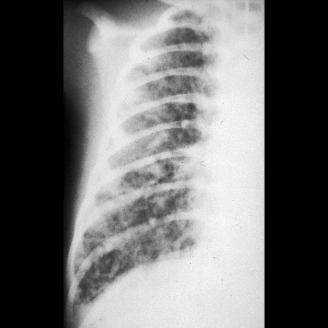 Respiratory Distress Syndrome | Pediatric Radiology Reference Article ...