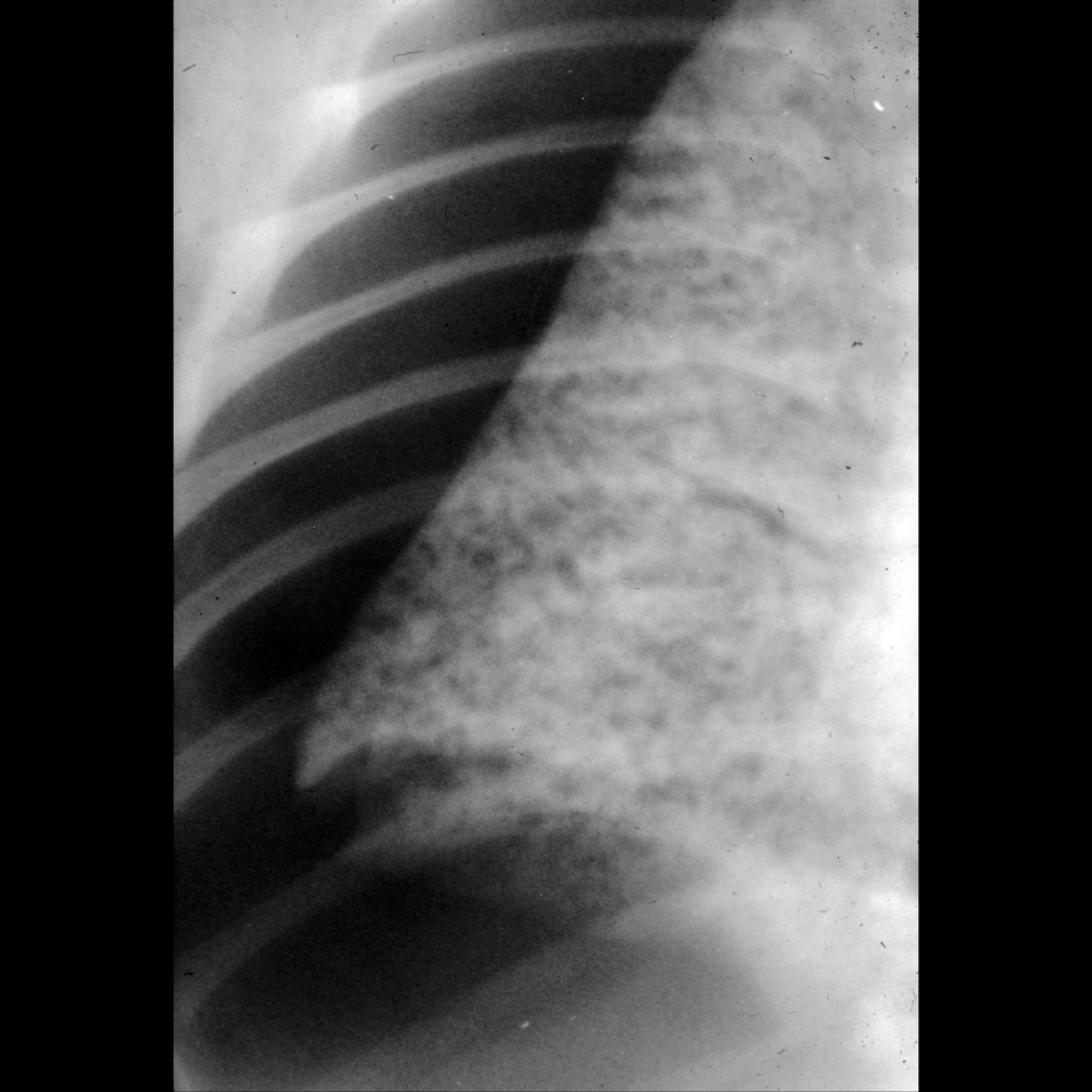 Pulmonary Interstitial Emphysema | Pediatric Radiology Reference ...