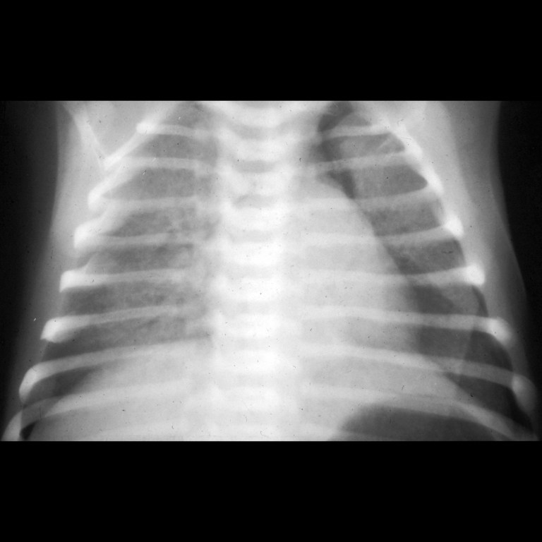 Pediatric Pneumothorax | Pediatric Radiology Reference Article ...