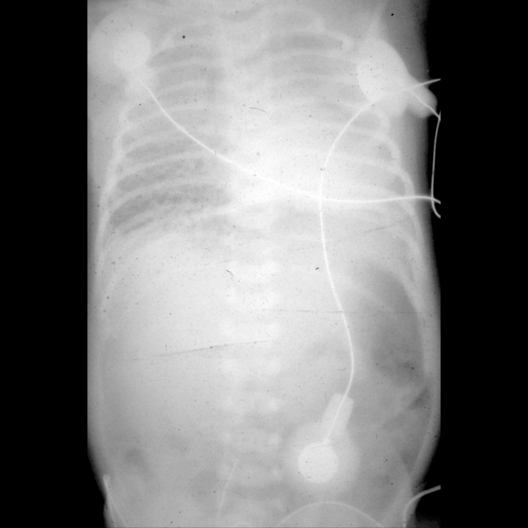 Pediatric Pneumoperitoneum | Pediatric Radiology Reference Article ...