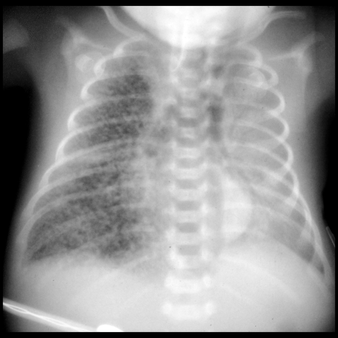Respiratory Distress Syndrome | Pediatric Radiology Reference Article ...
