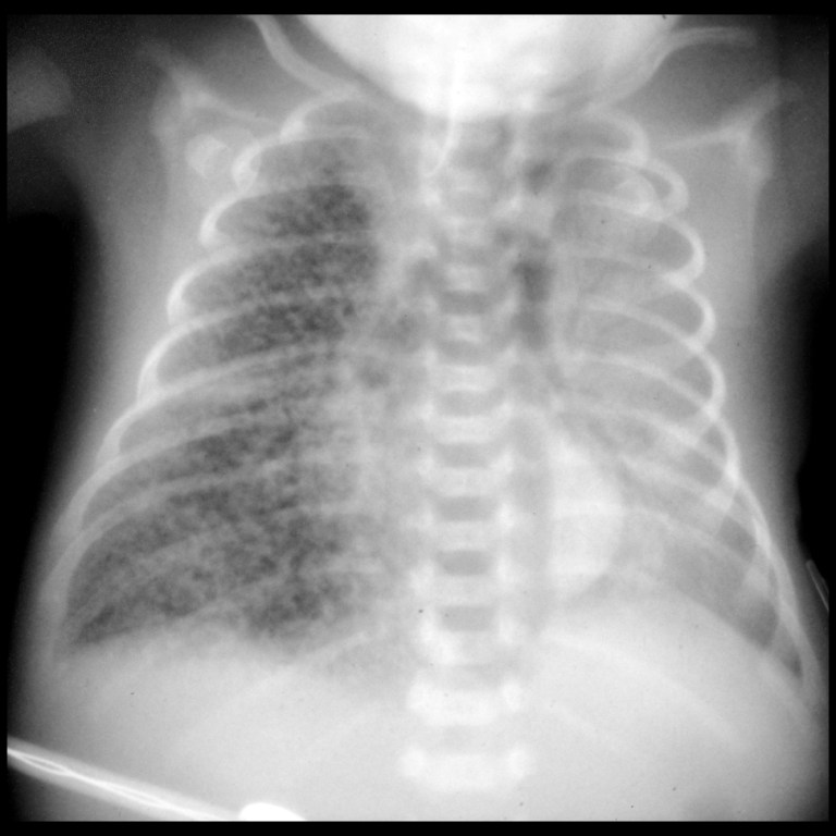 Pulmonary Interstitial Emphysema | Pediatric Radiology Reference ...