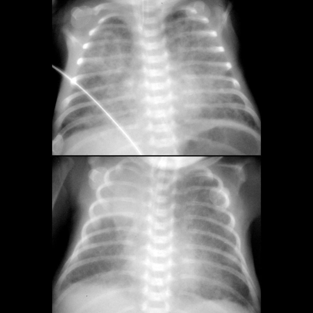 Respiratory Distress Syndrome | Pediatric Radiology Reference Article ...