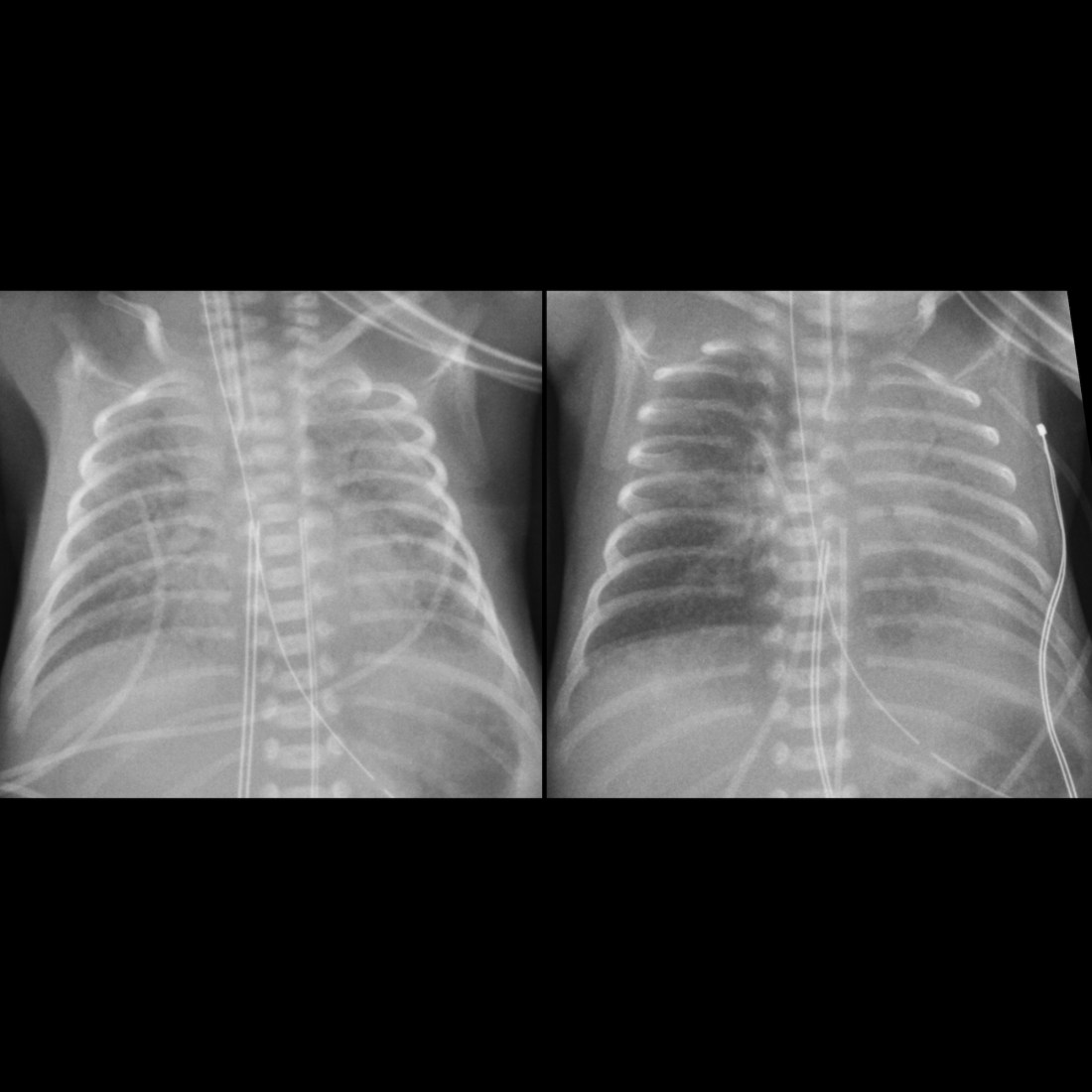 Respiratory Distress Syndrome | Pediatric Radiology Reference Article ...