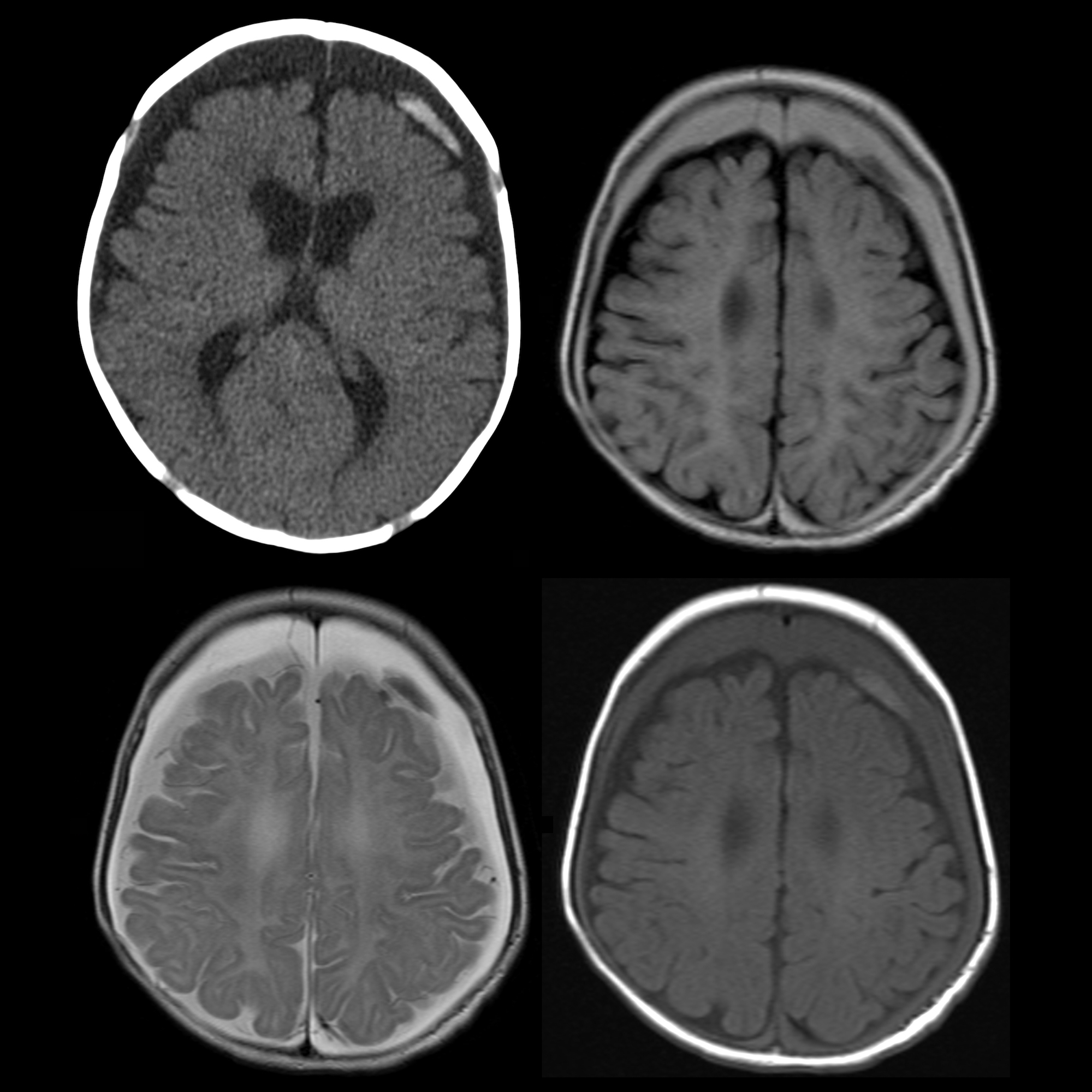 Pediatric Cerebral Atrophy | Pediatric Radiology Reference Article ...